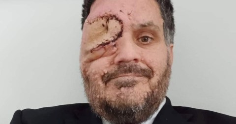 Man ordered out of restaurant ‘because his face was scaring customers’