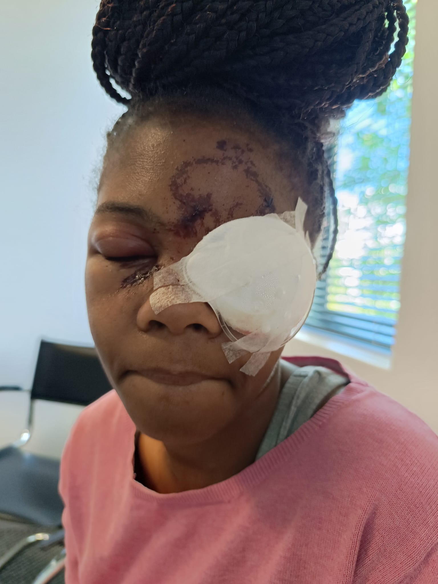 25-year-old South African woman loses left eye after man smashed her ...